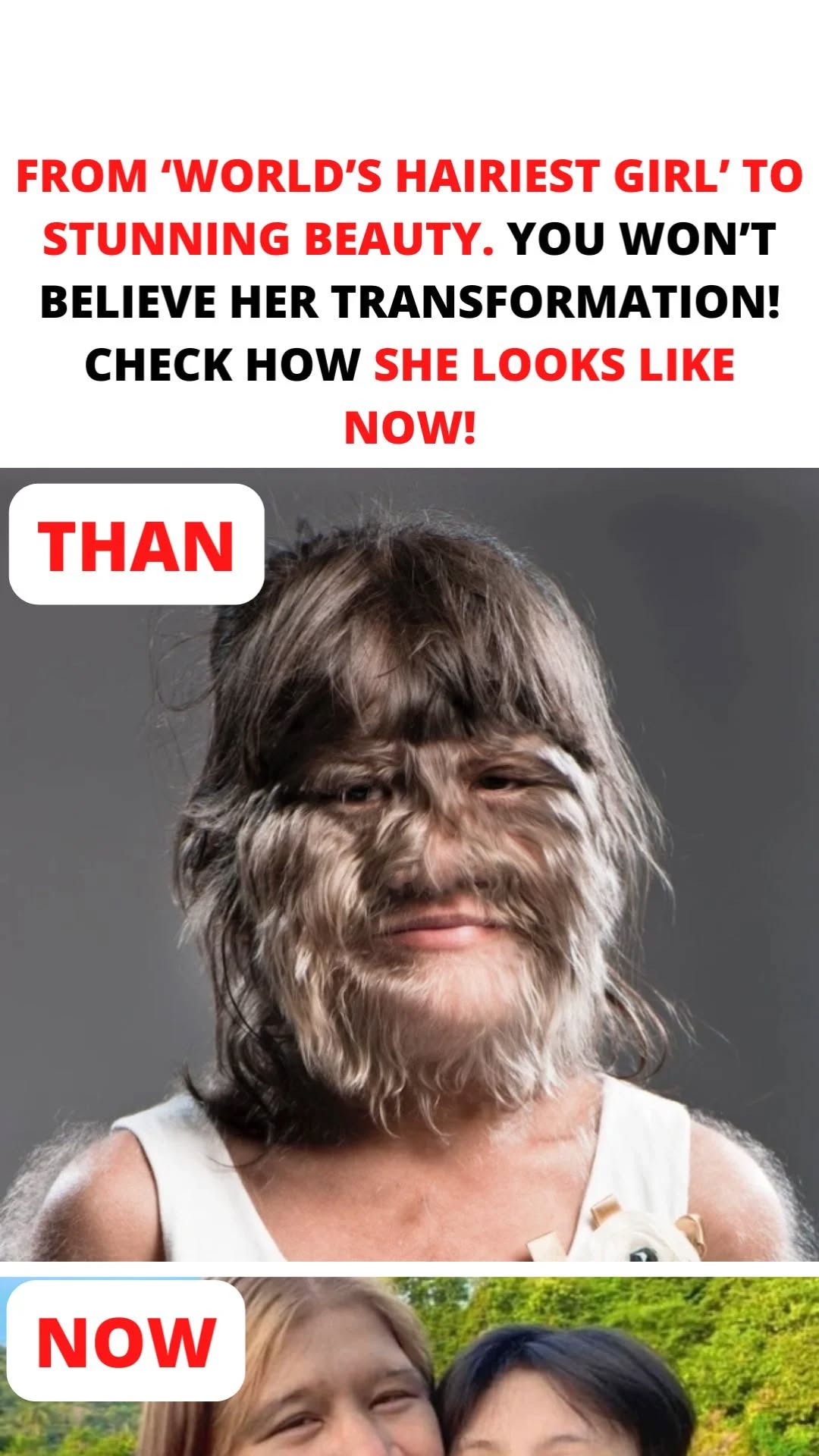 Once Called the ‘World’s Hairiest Girl,’ Now a Confident Woman in Love ...